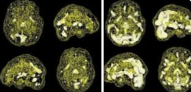 Different reasons for Dyslexia | DyslexiaClinics